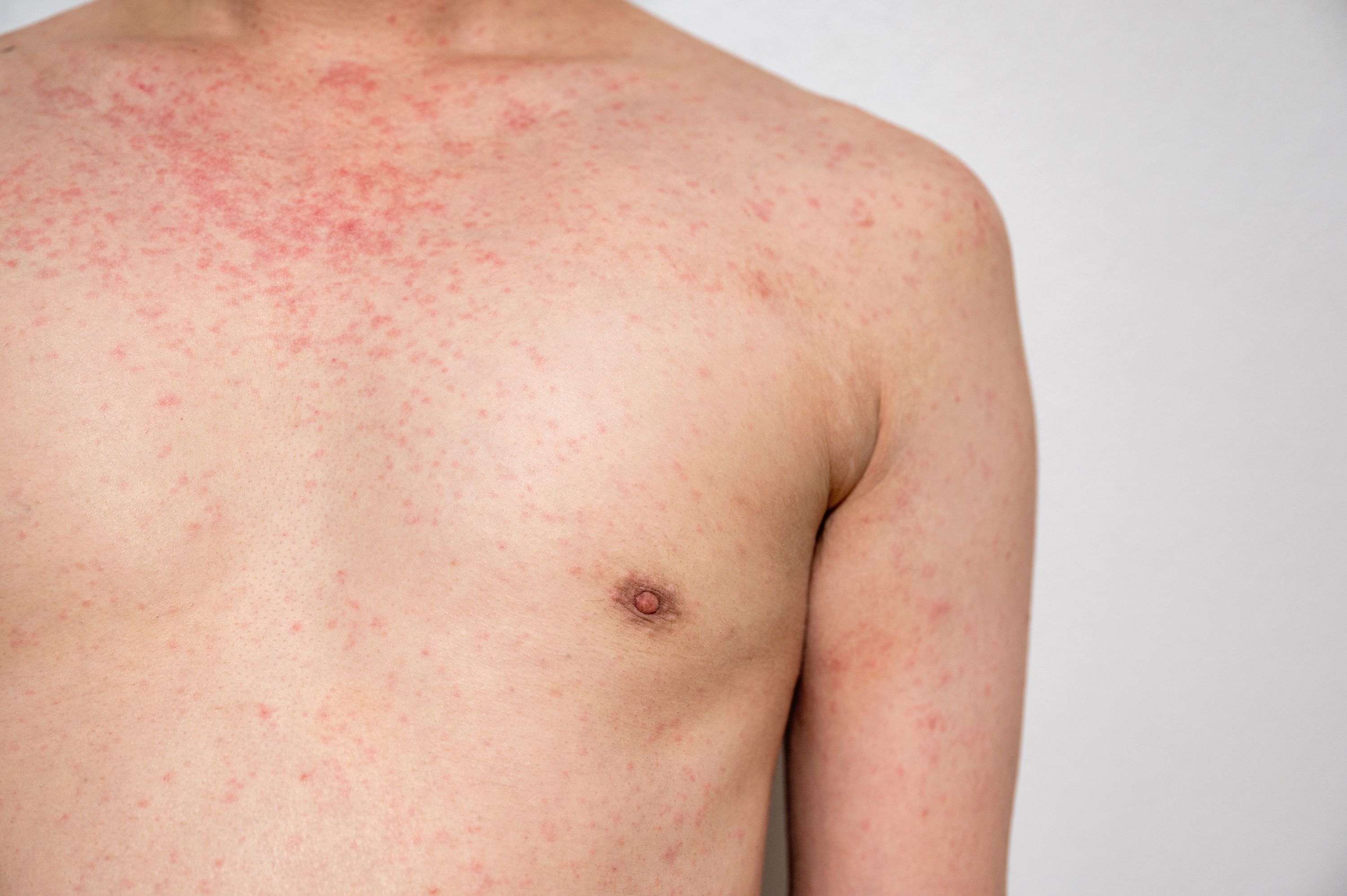 Measles cases surge across Manitoba, health officials urge vaccination ...
